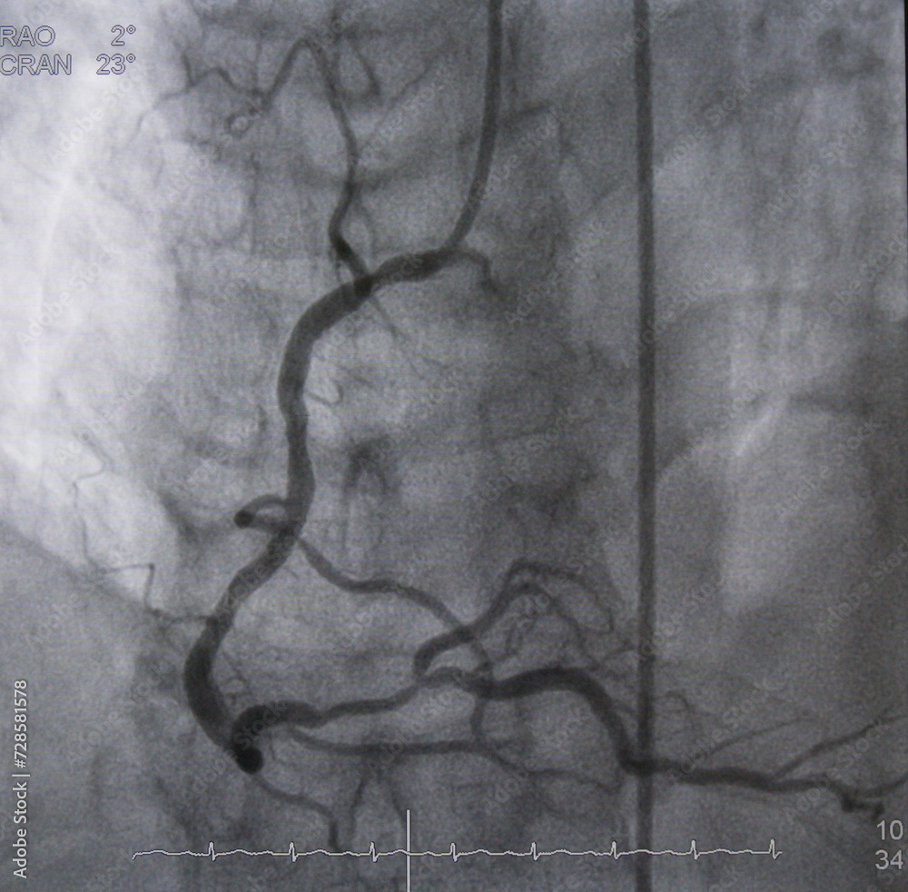 Coronary angiogram (CAG) was performed right coronary artery (RCA ...