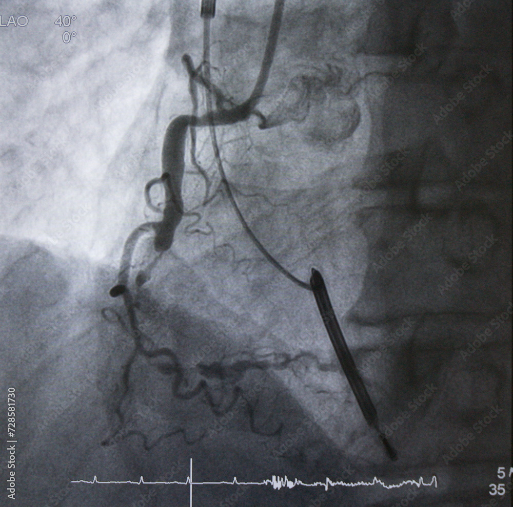 Coronary angiogram (CAG) was performed chronic total occlusion (CTO) at ...