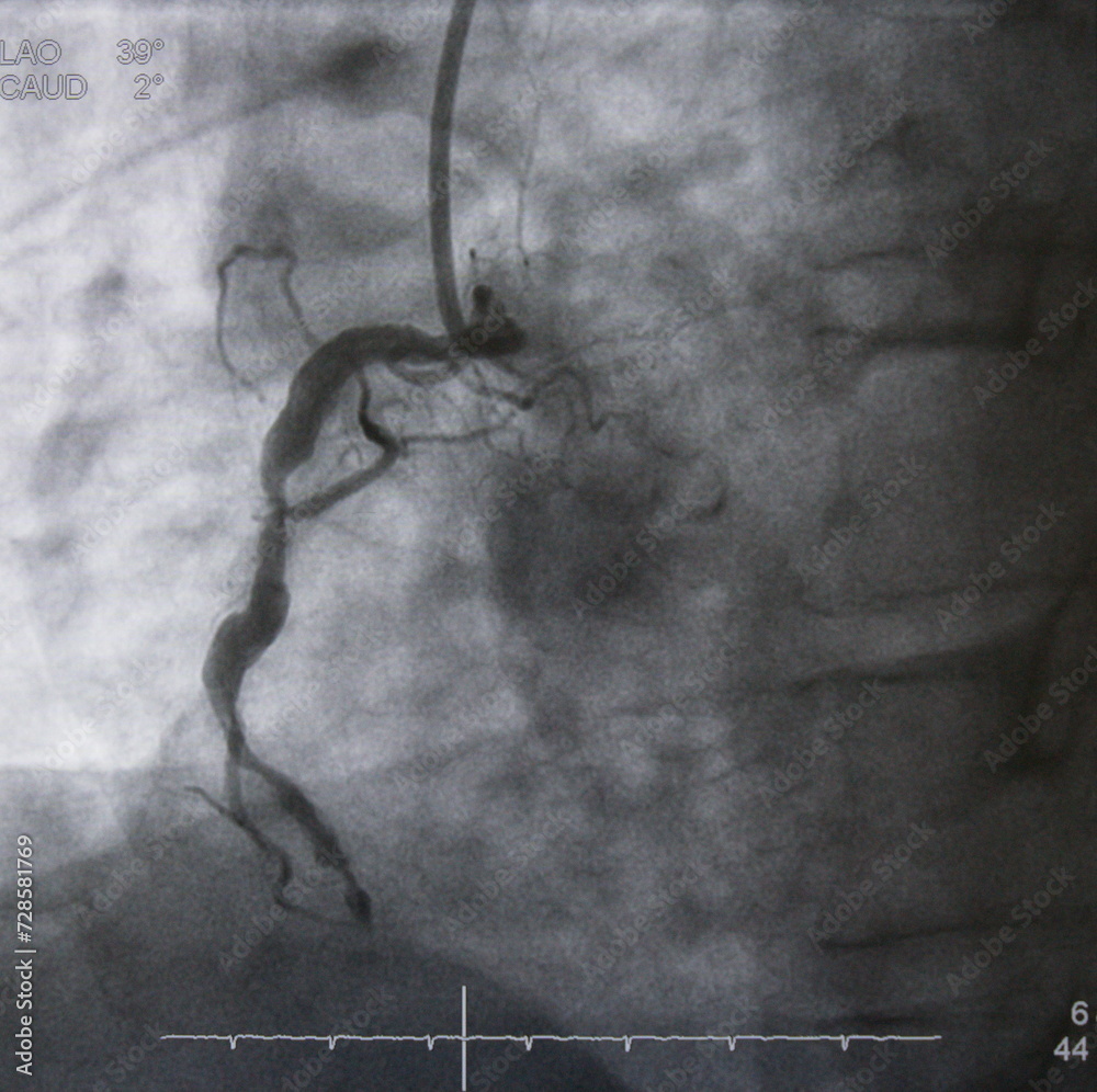 Coronary angiogram (CAG) was performed total occlusion at right ...