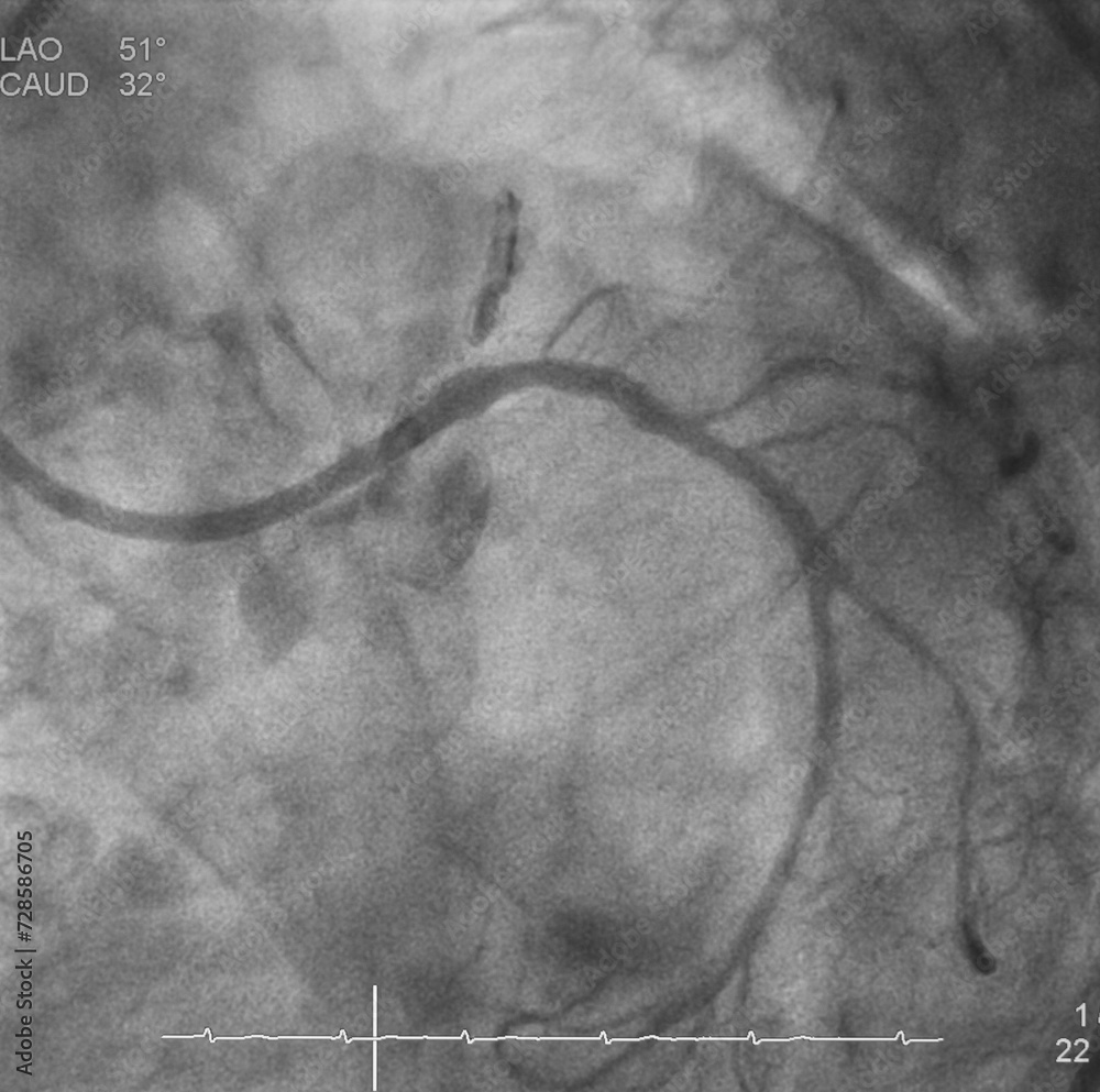 Coronary angiogram (CAG) was performed chronic total occlusion (CTO) at ...