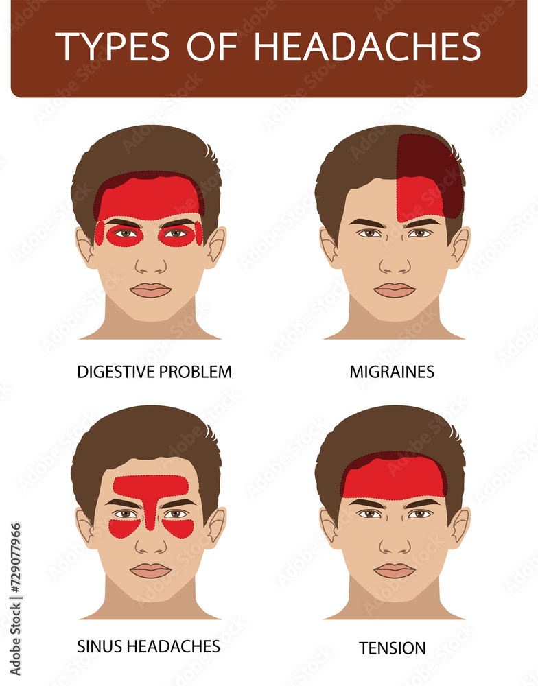 Types of headaches migraine, sinus, tension, digestive, illustration on ...