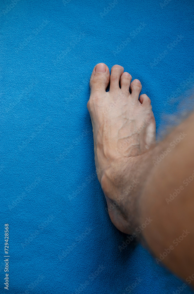 Pie masculino. Pie derecho de hombre joven con venas varicosas sobre ...