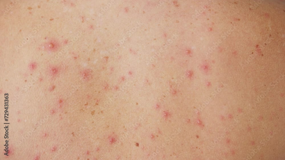 Back of adult have spotted, red pimple and bubble rash from chickenpox ...