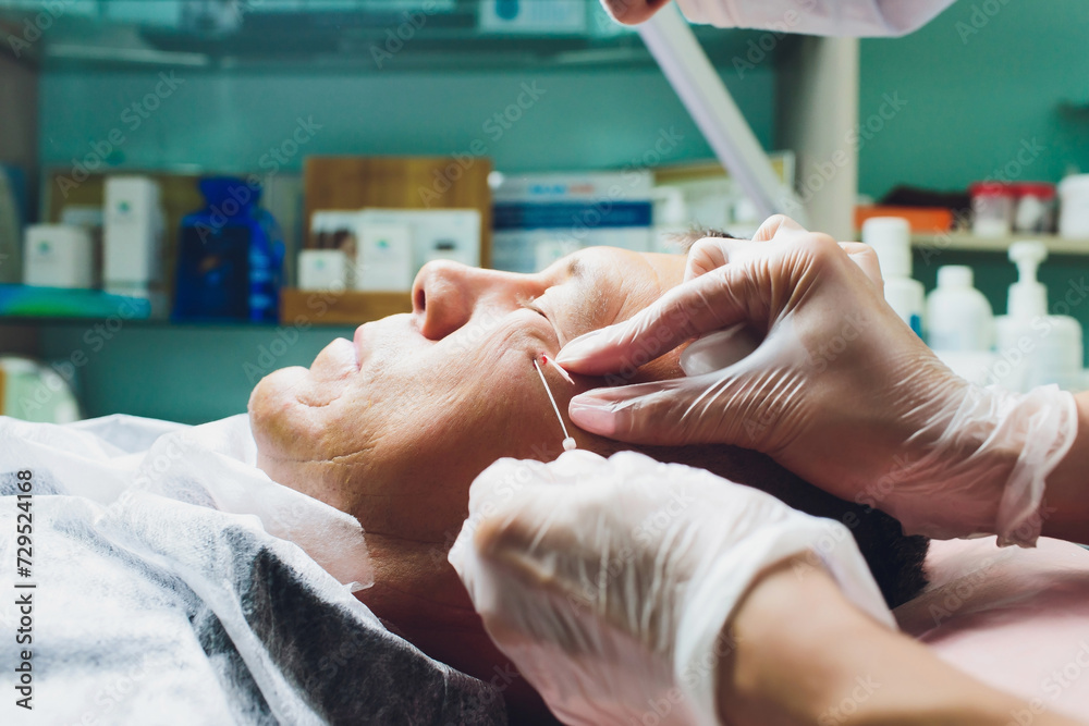 Close-up of procedure for face lifting PDO Suture operation, face ...