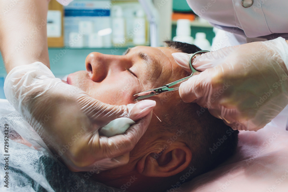 Close-up of procedure for face lifting PDO Suture operation, face ...