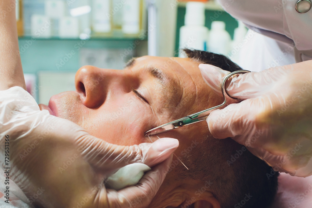 Close-up of procedure for face lifting PDO Suture operation, face ...