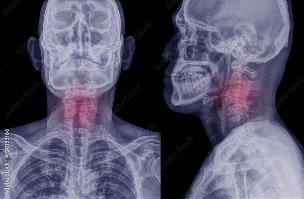 X-ray of the cervical spine to diagnose lateral deformity. The anterior ...