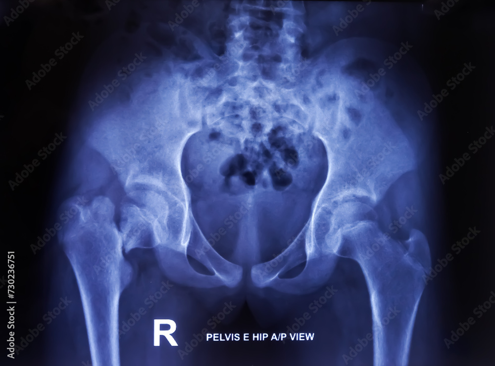 Pelvic x-ray of patient showing fracture of neck of femur with upward ...