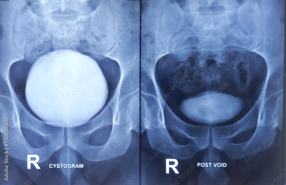 X-Ray film of RGU and MCU (Retrograde urethrogram and micturating ...