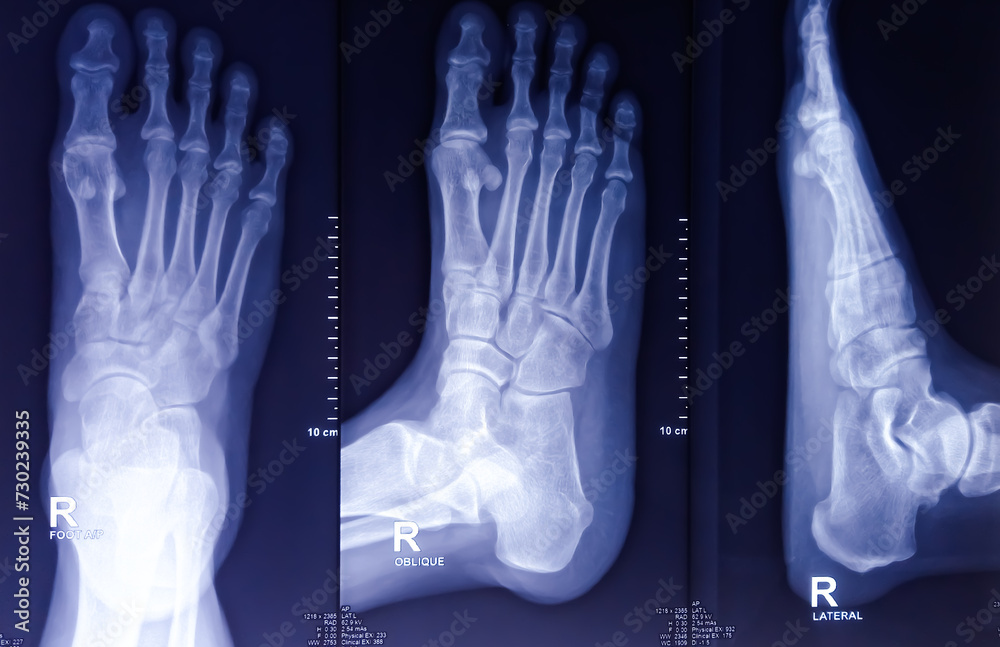 X-ray of foot both view. Fracture is noted at proximal phalanx on 4th ...