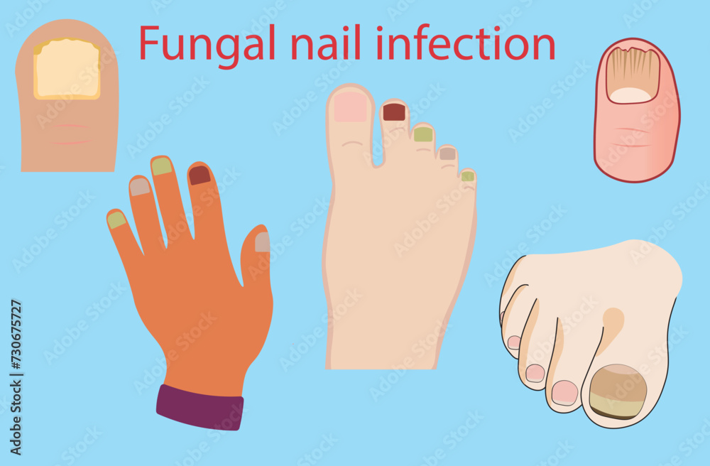 fungal,nail,infection,nail discoloured, thickened and distorted,nail ...