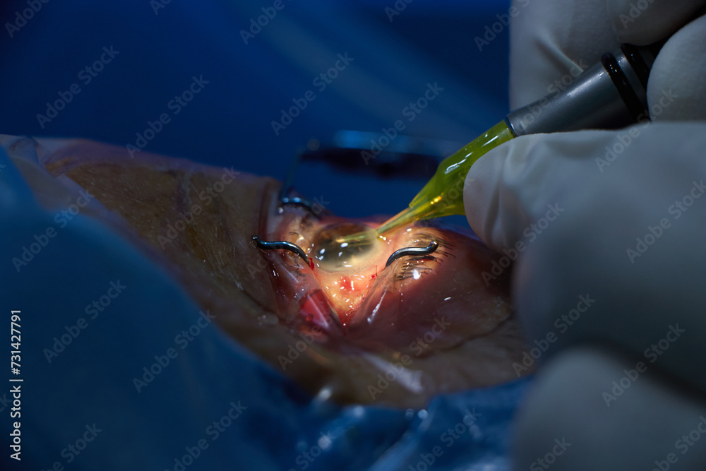 Phacoemulsification, destruction of the opaque lens by ultrasound ...