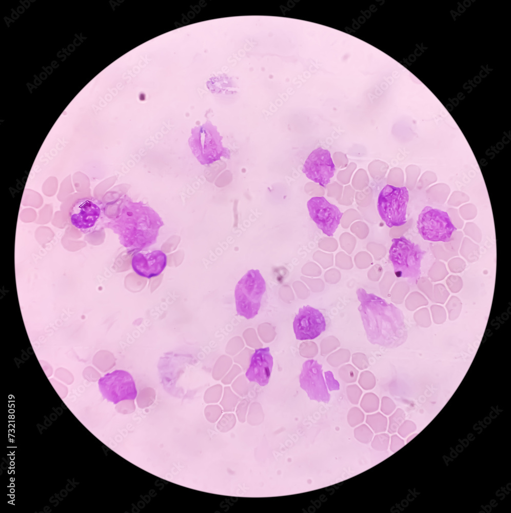Acute myeloid leukemia (AML). Smear show shift maturation of then are ...