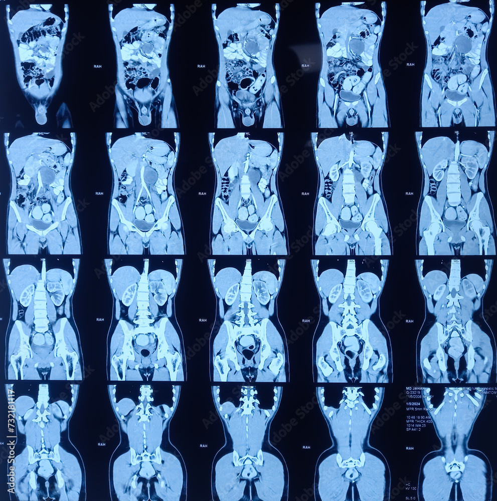 CT (computerized tomography) urogram. Spindle cell tumor of left testis ...