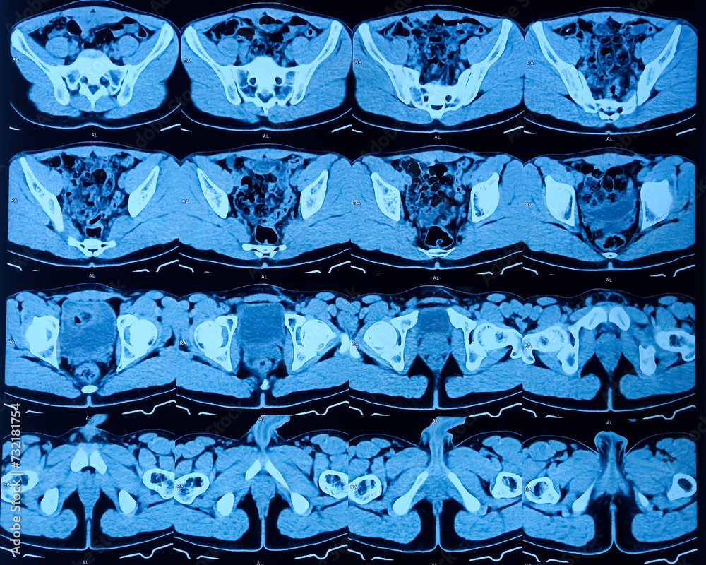 CT (computerized tomography) urogram. Spindle cell tumor of left testis ...