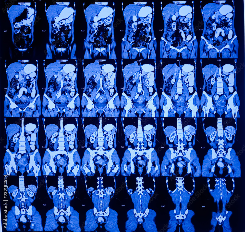 Cervix carcinoma. CT scan of cervix of uterus. Cu-T noted in situ in ...