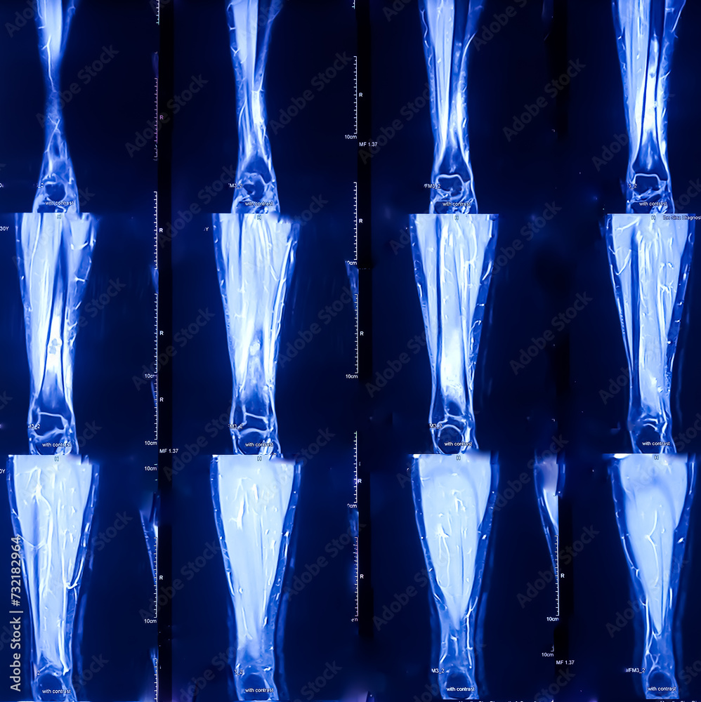 MRI (Magnetic resonance imaging) scan of leg. Lytic bony lesion at ...