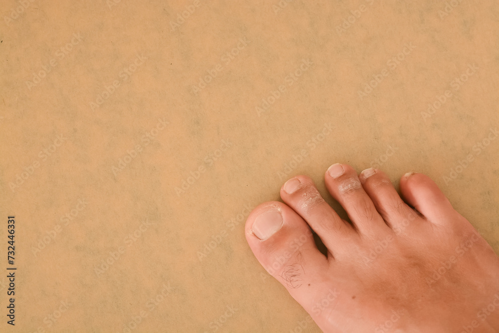 Athlete's foot, medically known as tinea pedis, fungal infection ...