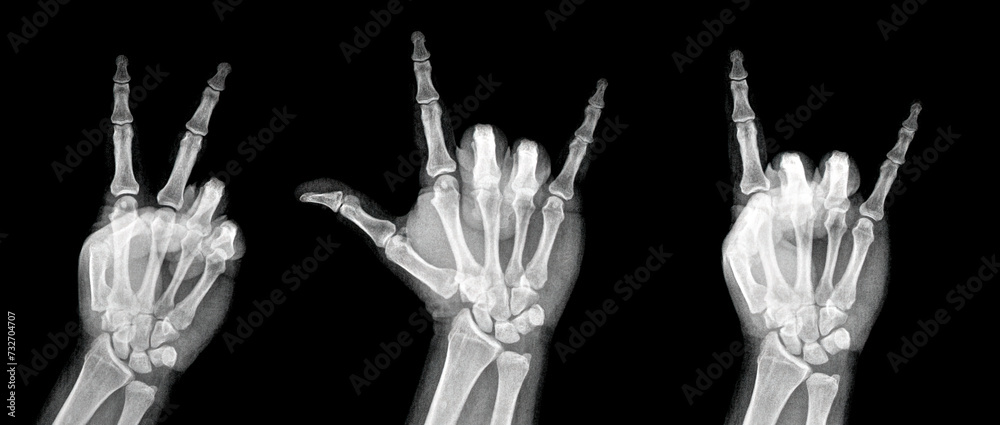 Film xray x-ray or radiograph of a hand and fingers showing the peace ...
