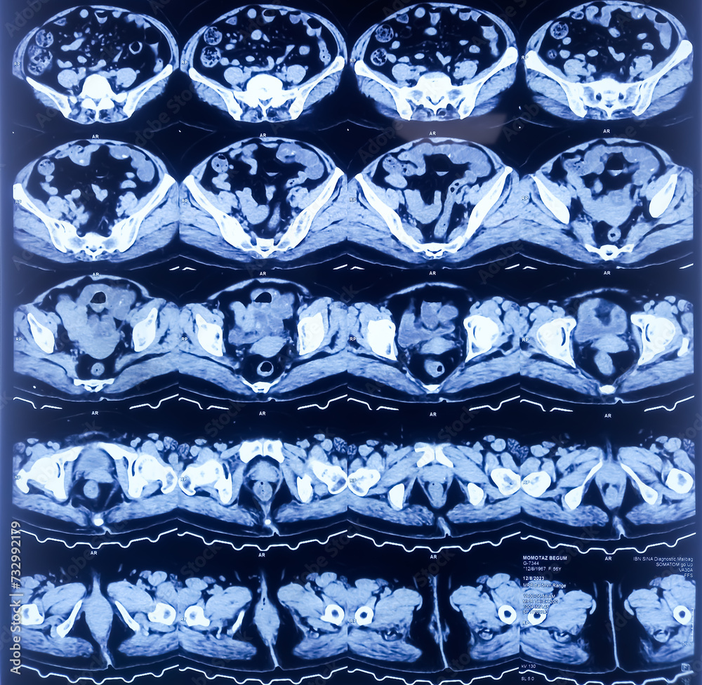MRI (magnetic resonance imaging) of Lumbo sacral Spine. Degenerative ...