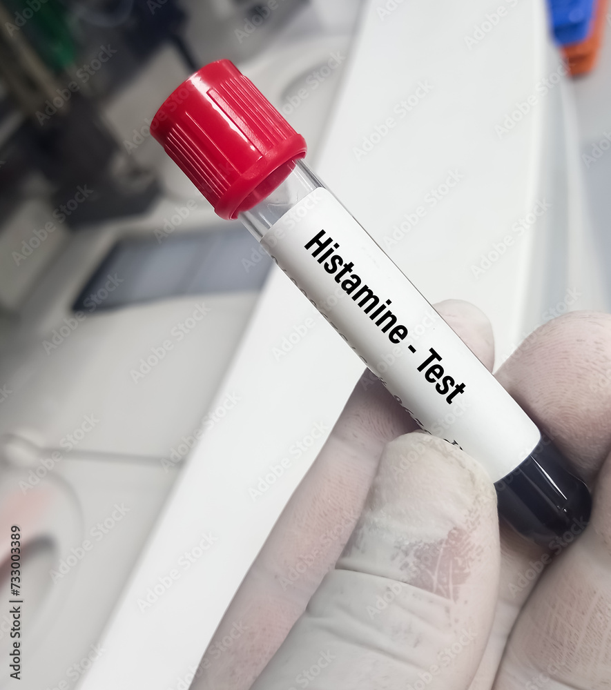 Blood sample for Histamine blood test, to diagnosis of anaphylaxis ...