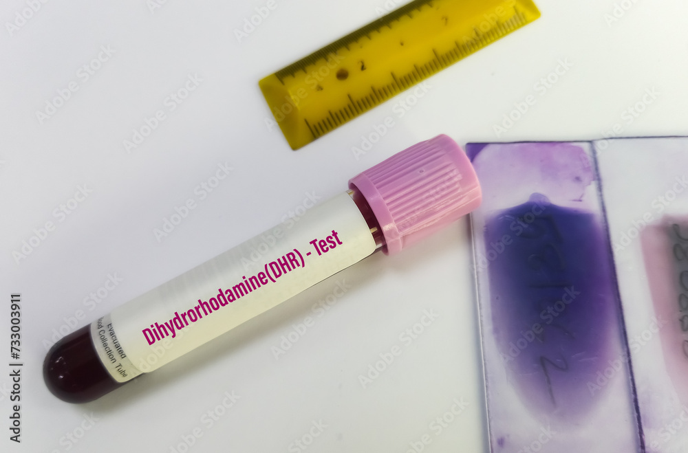 Blood sample for DHR (Dihydrorhodamine) or Neutrophil Function Test for ...