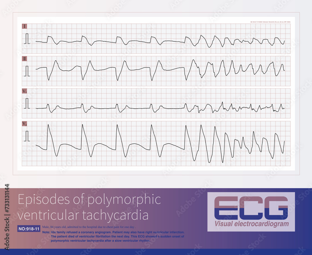Male, 84 years old, admitted to hospital with chest pain for 1 day. ECG ...