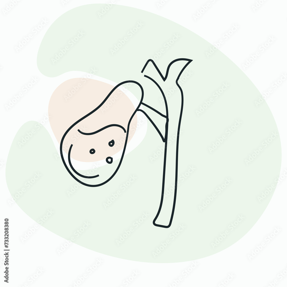 Cholecystectomy is a surgical procedure performed to remove the ...