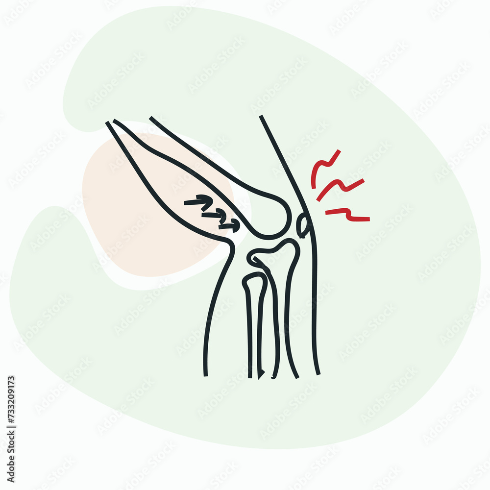 Knee replacement surgery, also known as knee arthroplasty, is a ...