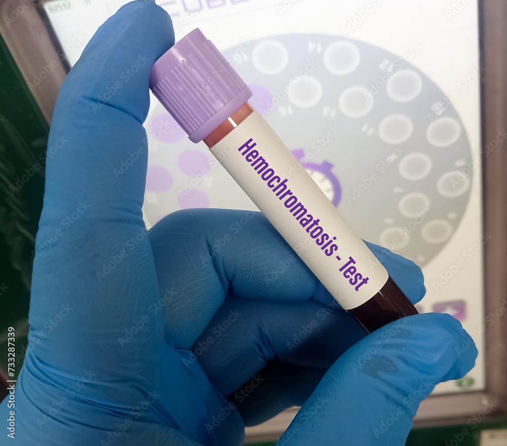 Blood sample for Hemochromatosis test, a disorder in which the body can ...