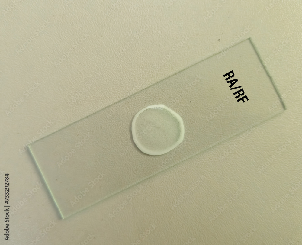 Blood agglutination test for RA or RF test, to diagnosis of Rheumatoid ...