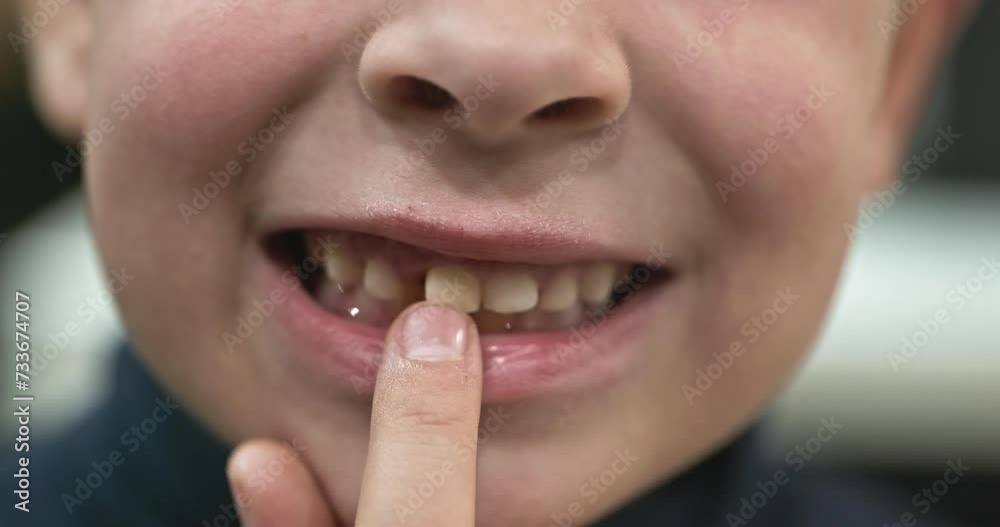 Stockvideon Kid Boy Shows Wobbly Loose Milk Baby Tooth. Child Wobbling ...