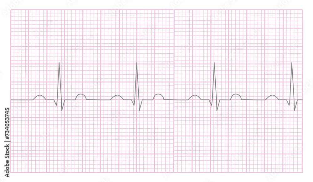 The picture of Electrocardiogram (ECG) or Electrocardiography (EKG ...