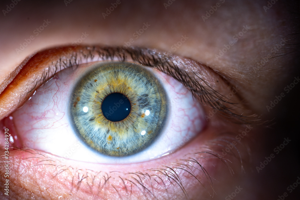 Female Blue-Green Colored Eye with brown pigment spots. Pupil Opened ...