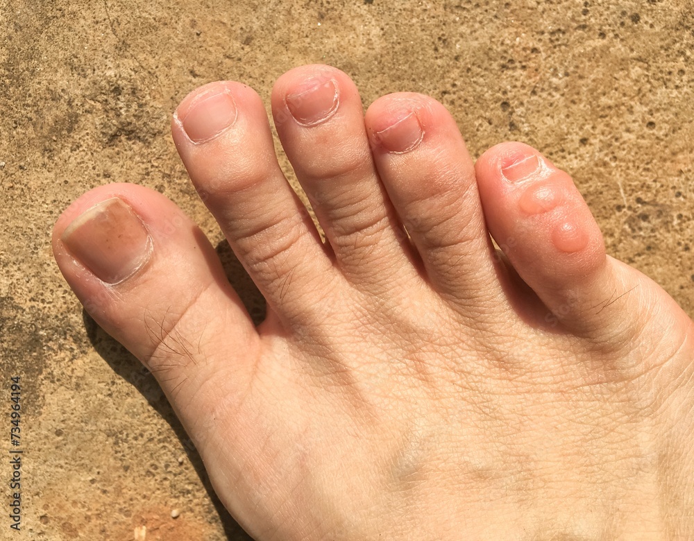 The friction blisters on the little toe. The vesicle on the skin of ...