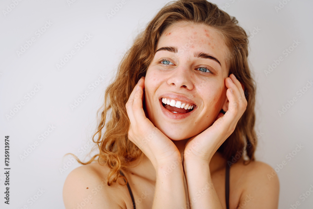 Young woman with problem skin. Life with acne. Problem skin prone to ...