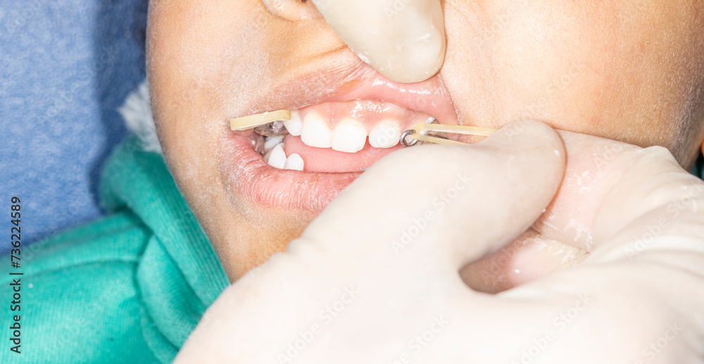 Fingers with orthodontic dentist's gloves connecting the maxillary ...
