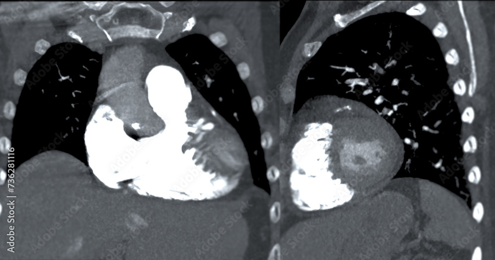 A CTA pulmonary artery reveals a detailed view of the lung blood ...