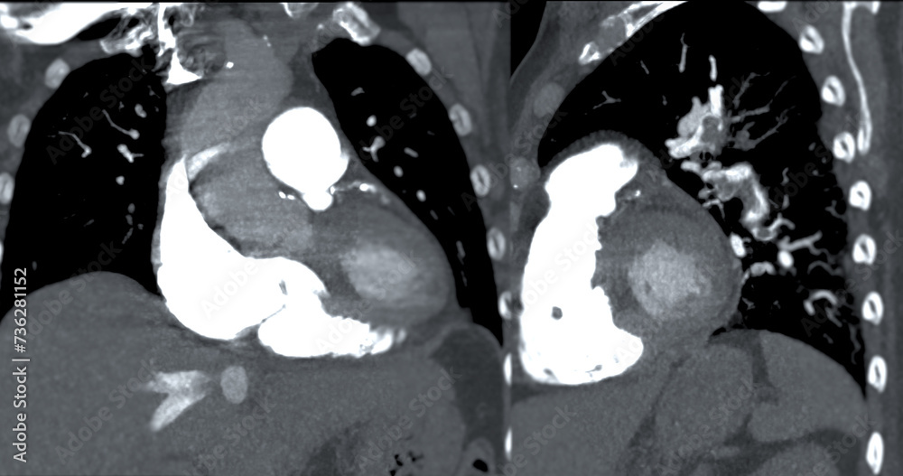 A CTA pulmonary artery reveals a detailed view of the lung blood ...