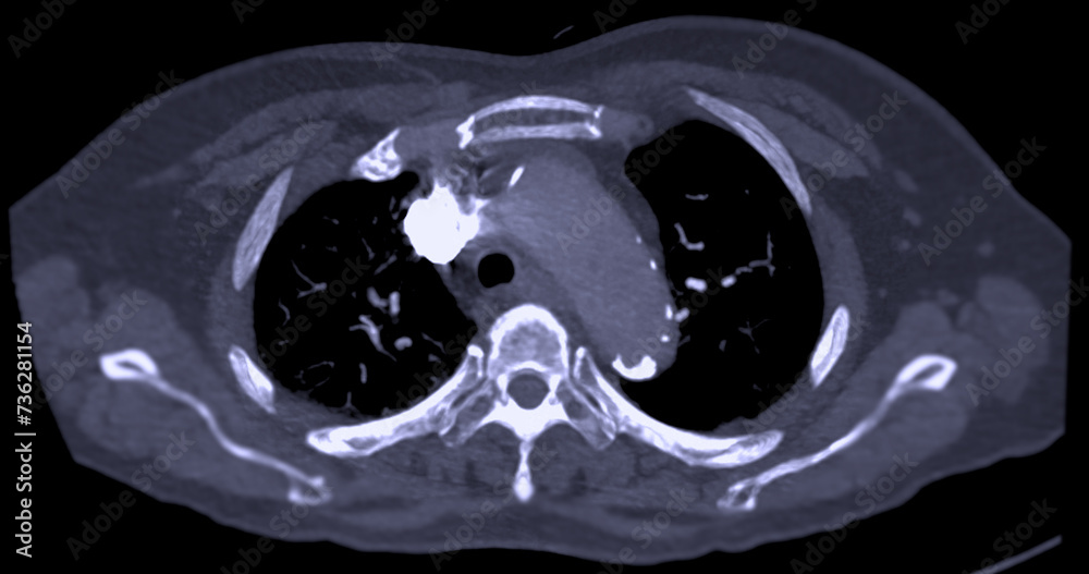 A CTA pulmonary artery reveals a detailed view of the lung blood ...