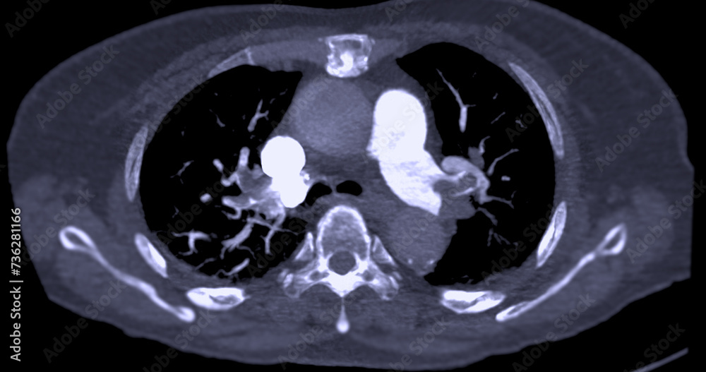 A CTA pulmonary artery reveals a detailed view of the lung blood ...