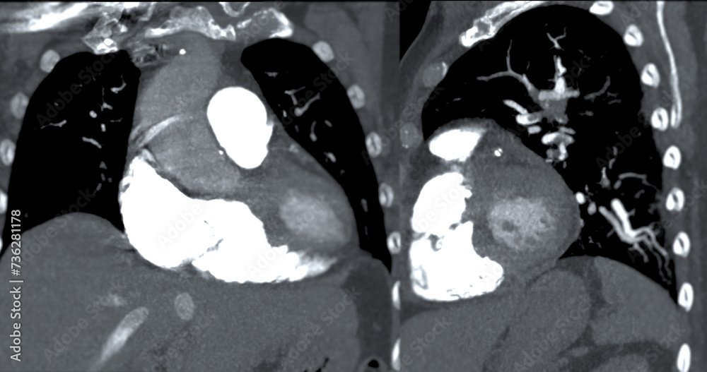 A CTA pulmonary artery reveals a detailed view of the lung blood ...