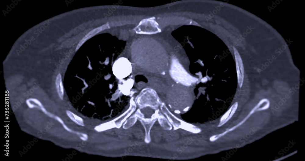 A CTA pulmonary artery reveals a detailed view of the lung blood ...