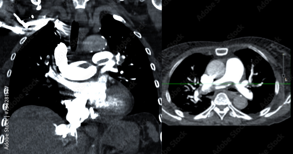 A CTA pulmonary artery reveals a detailed view of the lung blood ...