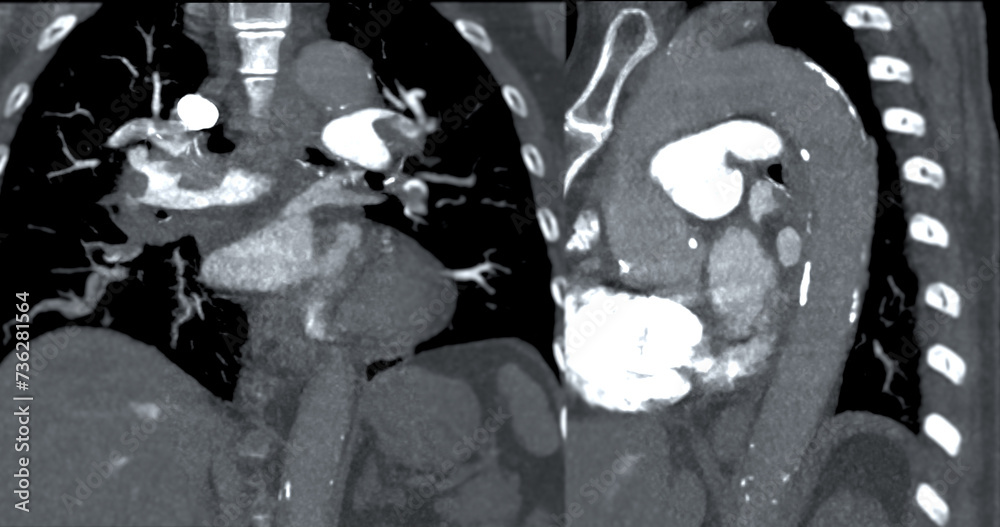 A CTA pulmonary artery reveals a detailed view of the lung blood ...