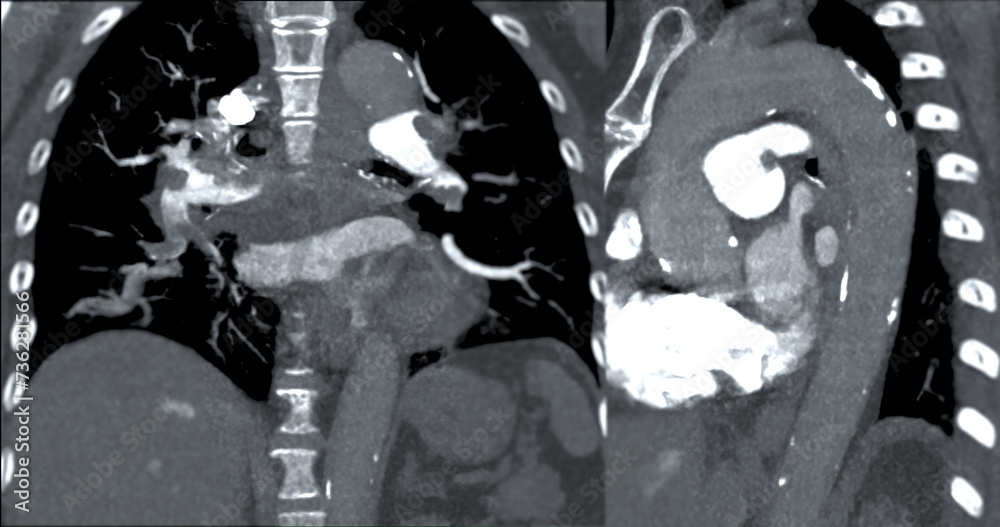 A CTA pulmonary artery reveals a detailed view of the lung blood ...