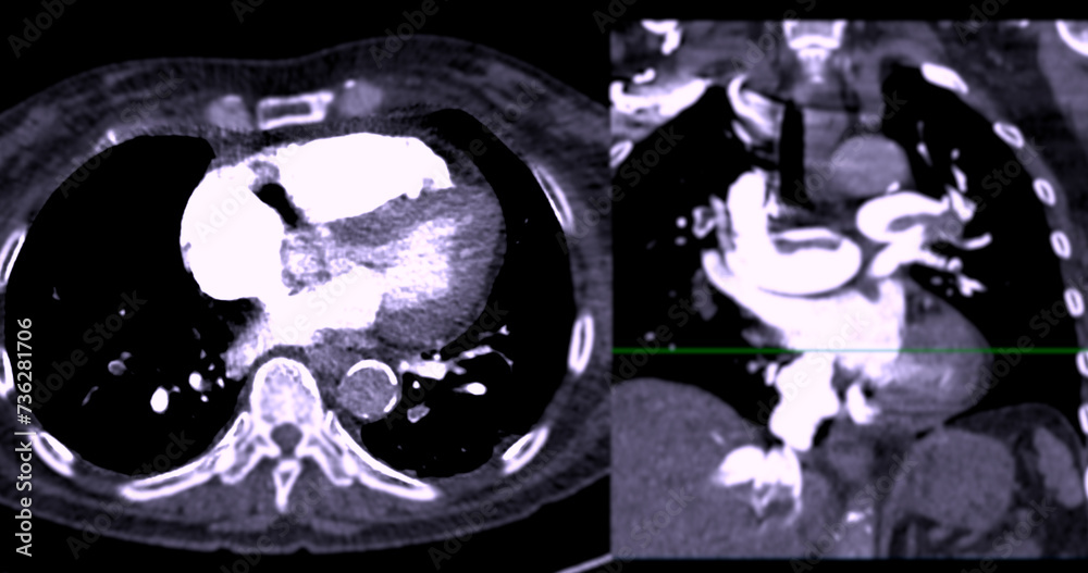 ภาพประกอบสต็อก A CTA pulmonary artery reveals a detailed view of the ...