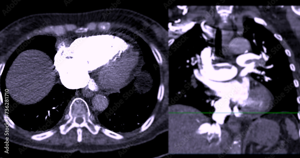 A CTA pulmonary artery reveals a detailed view of the lung blood ...