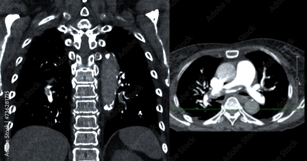 A CTA pulmonary artery reveals a detailed view of the lung blood ...