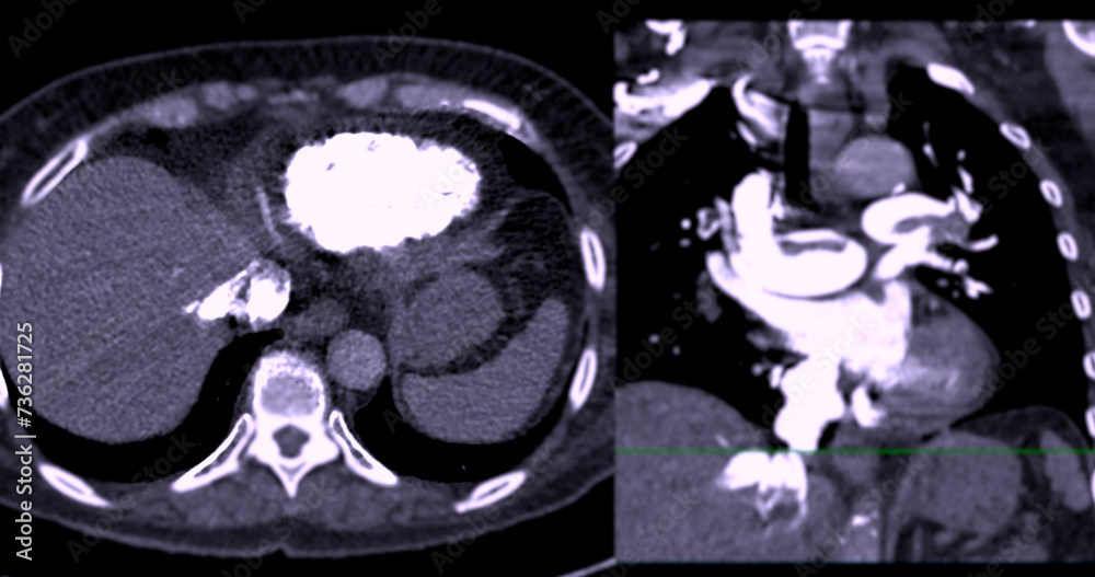 A CTA pulmonary artery reveals a detailed view of the lung blood ...